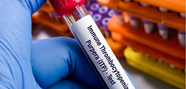 Idiopathic Thrombocytopenic Purpura in Children - Care Options for Kids