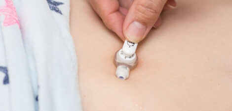 Jejunostomy (J-Tube): Procedure, Care & More - Care Options for Kids