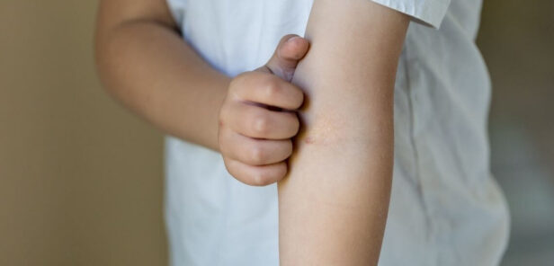 Scabies in Children: How to Care for a Child with Scabies - Care ...