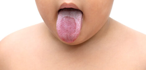 Candidiasis bucal en bebés - Opciones de cuidados para los niños